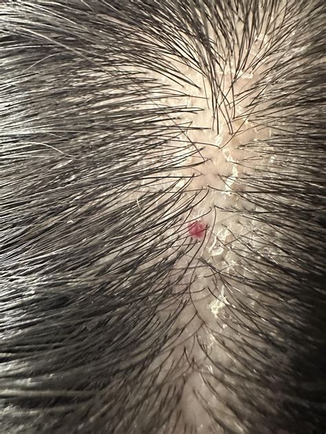 Red Mark On Scalp R Askdocs