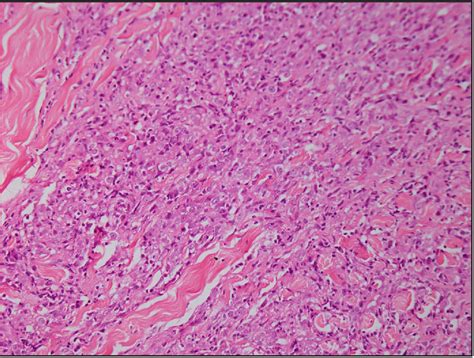 Anaplastic Lymphoma Kinase Alk Negative Systemic Anaplastic Large Cell Lymphoma Presenting As
