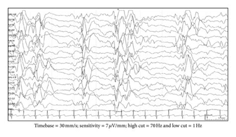Eeg Findings In Hypsarrhythmia Burst Suppression Variant There Are
