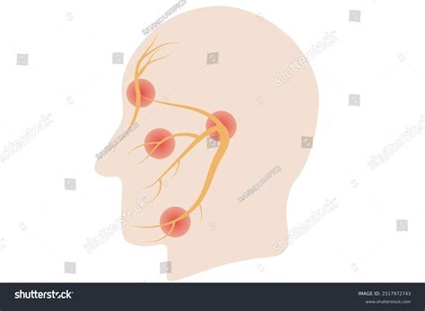 Trigeminal Neuralgiafacial Pain Due Trigeminal Nerve Stock Vector