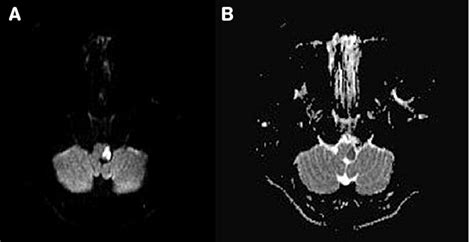 A Small Lesion With Diffusion Restriction Was Found In The Left Lateral