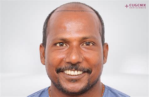 Niranjan Reddy Norwood Class 7 Hair Transplant Results And Hair