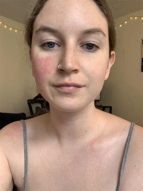 1110 Best Rrosacea Images On Pholder Been Two Weeks On Noritate 1