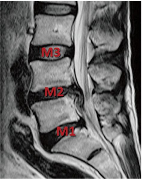 Lumbosacral Transition Vertebra Prevalence And Its Significance Pmc