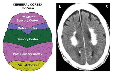 Postsensory Cortex Constellation