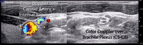 Regional Anesthesia Interscalene Block