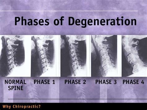 Trigeminal Neuralgia Ppt Brain And Nervous System Disorders Diseases And Conditions
