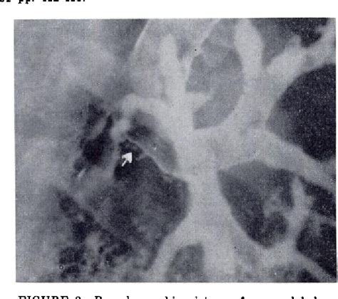 Figure 2 From Bronchoscopic Criteria For The Diagnosis Of Tuberculous Lymph Node Perforation