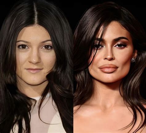 Kylie Jenner Nose Job Celebrity Plastic Surgery Before And After