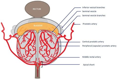 Jpm Free Full Text Prostate Artery Embolization Challenges Tips Tricks And Perspectives
