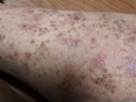 이거 병명이 뭔가요 지식in