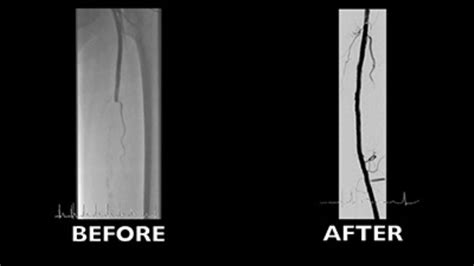 Video Sfa Occlusion Treated With A Supera Stent