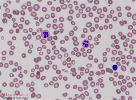 Macrocytosis Learnhaem Haematology Made Simple