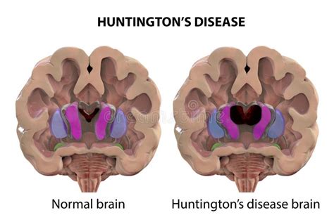 Huntington S Disease A Neurodegenerative Disease Due To Mutation In The Huntingtin Gene Htt
