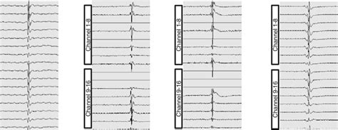Representative Biphasic Waveform Recordings Representative Recordings