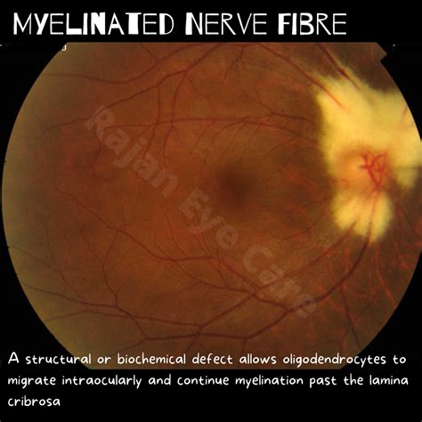 Myelinated Nerve Fibre — Ophthalmobytes