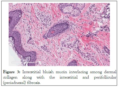 Congenital Localized Scleroderma A Rare Presentation In A Newbor