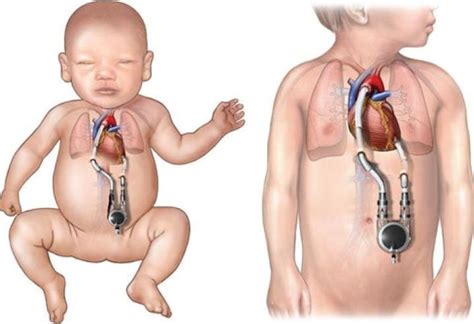 Berlin Heart Excor 22 Download Scientific Diagram