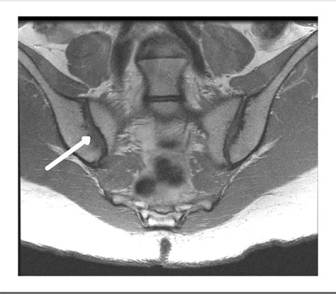 Figure 1 From Mri Assessment Of Sacroiliitis With High Resolution Protocol Semantic Scholar