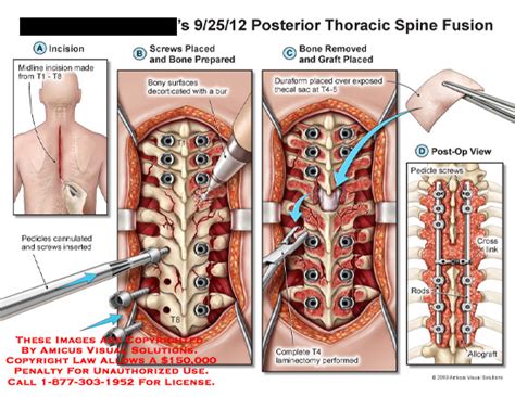 Posterior Thoracic Spine Fusion