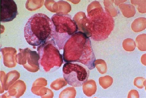 Promyelocytic Leukemia Aml M3 Download Scientific Diagram