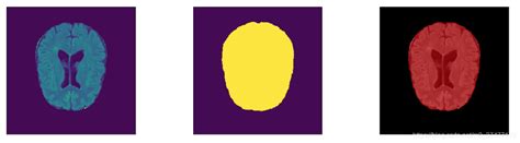 【医疗影像处理】erosion And Dilation Of Medical Images Masks Using Scipy