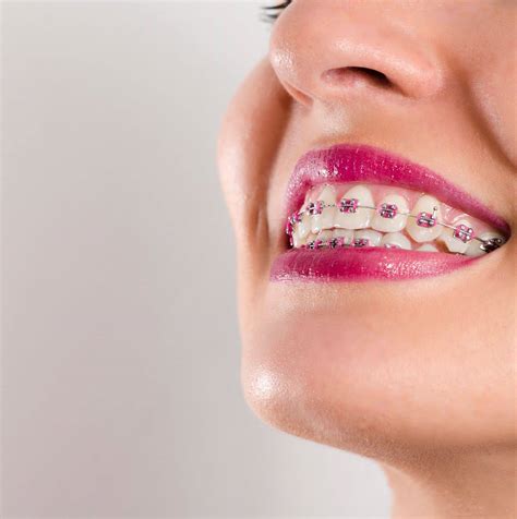 Key Benefits Of Braces Treatment Peak Orthodontics