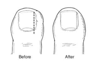 Ingrown Toenails Wedge Resections Kingsley Medical More Than Your Local Gp