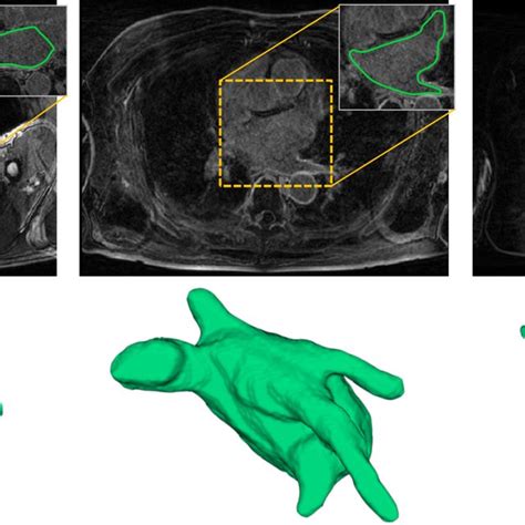 Challenges In Segmenting The Left Atrium And Associated Pulmonary