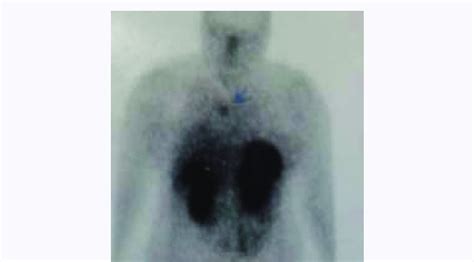 Octreotide Scan Which Showed Pathological Uptake In The Right Side Area Download Scientific