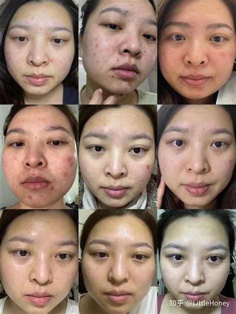 治痘历程记录（已治好，回顾记录） 知乎