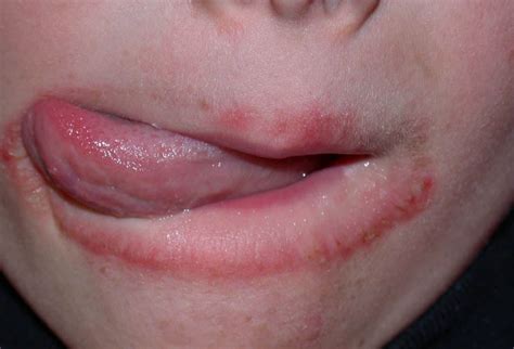 Lip Rash Causes Pictures On Upper And Treatments Healthyesta