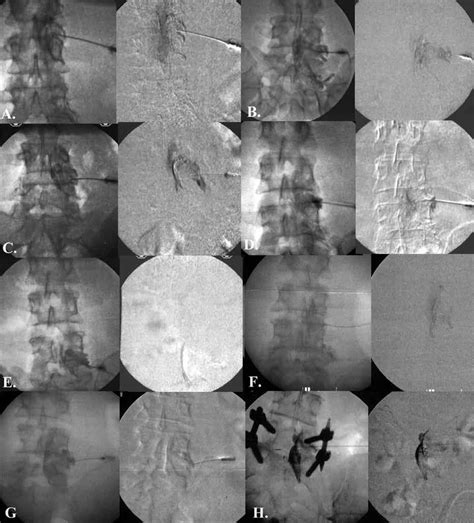 Contrast Medium Pattern Produced By Alternative Tfesi Approach Download Scientific Diagram