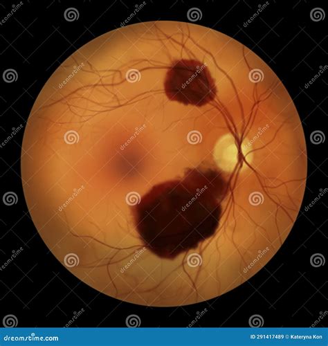 A Subretinal Hemorrhage As Observed During Ophthalmoscopy 3d