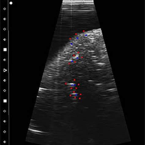 Liver Vessels Used As Tracking Features To Assess Organ Motion
