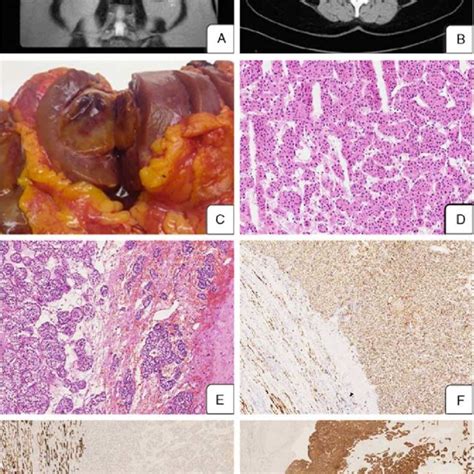 A Solid Partially Esophytic Renal Mass Occupying The Middle And Lower Download Scientific