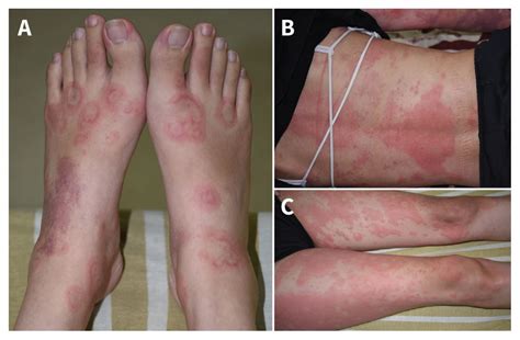 Hyperthyroidism Rash