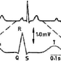 Typical Patterns Of ECG Signals Download Scientific Diagram