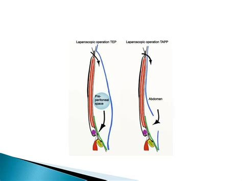 Laparoscopic Repair Of Inguinal Hernia Pptx