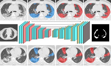 How AI Can Improve Chest Imaging Of COVID Master BME