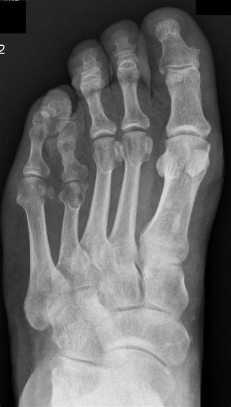 Pediatric Ankle And Foot Injuries Sciencedirect 59 Off