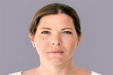 Cari Obat Melasma Paling Ampuh Ini Dia Daftarnya Lengkap