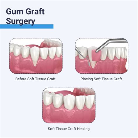 Gum Graft Franklin Square Ny Gum Grafting Surgery Nassau County