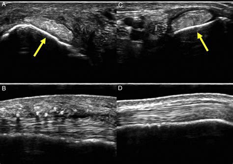 Postoperative Repeat Dislocation Of The Posterior Tibial Tendon A Case