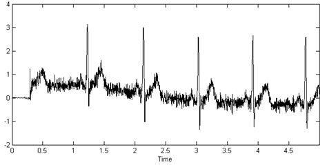 ecg signal before application of notch filter download scientific