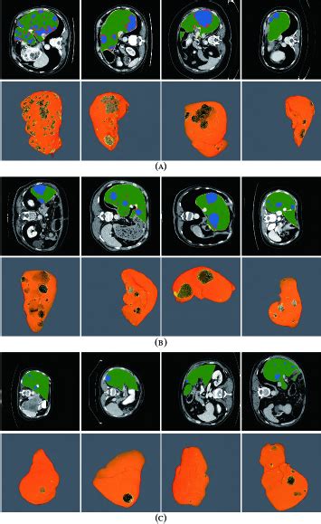 181101328 Ra Unet A Hybrid Deep Attention Aware Network To Extract Liver And Tumor In Ct Scans