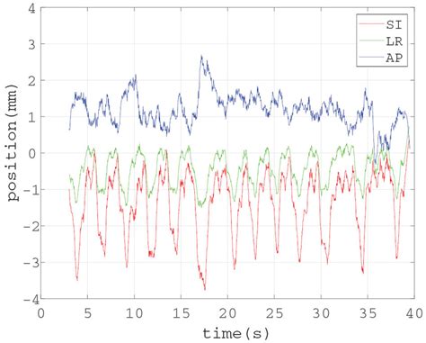 An Example Of Lung Tumor Motion Trajectory Of A Patient Measured With