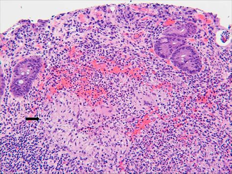 Colonic Mucosa With Aulcerated Surface Lamina Propria Expanded By