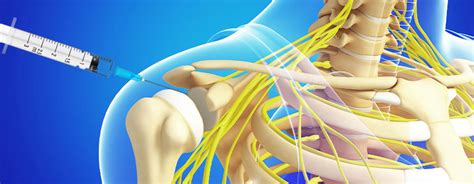 Subacromial Injections Allen Subacromial Injections For Auto Accident Injuries