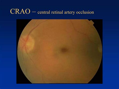 Retinal Disease Lecture Optometry Optometri Ppt